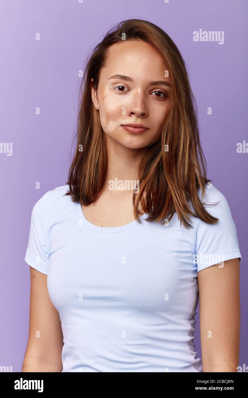 slim nice young woman has disturbance of skin color. close up portrait ...