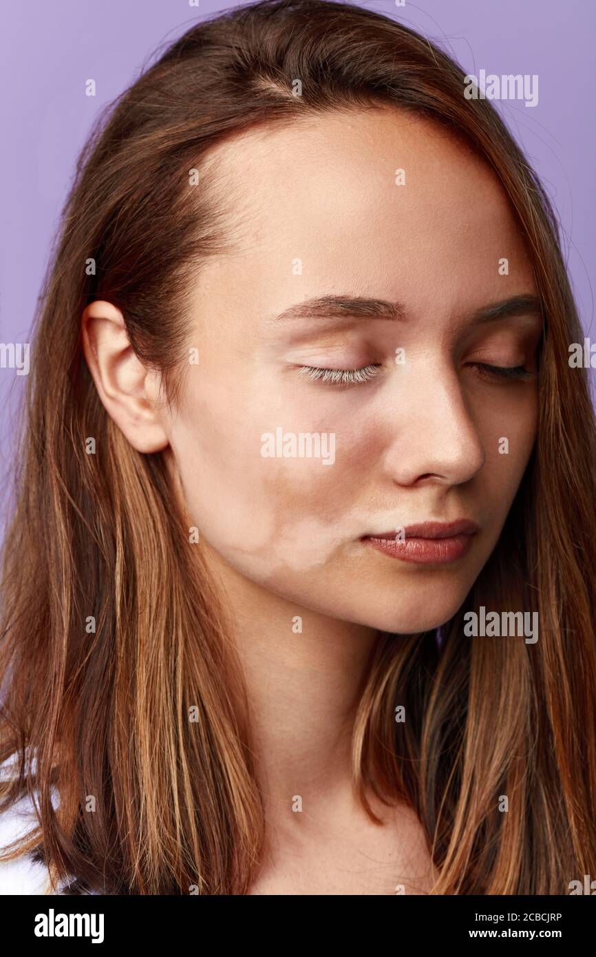 Pigment spots hi-res stock photography and images - Alamy