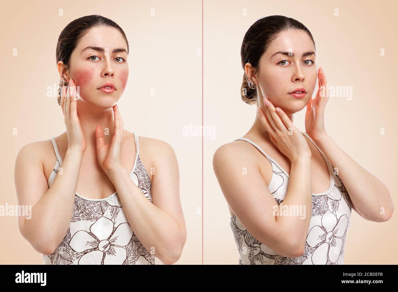 Portrait of a young Caucasian woman showing redness and inflamed blood ...