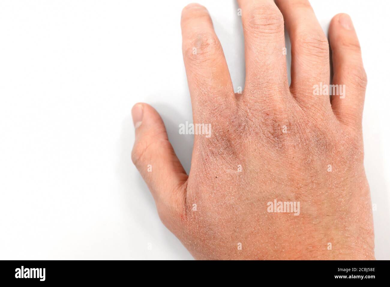Cracked skin hi-res stock photography and images - Alamy