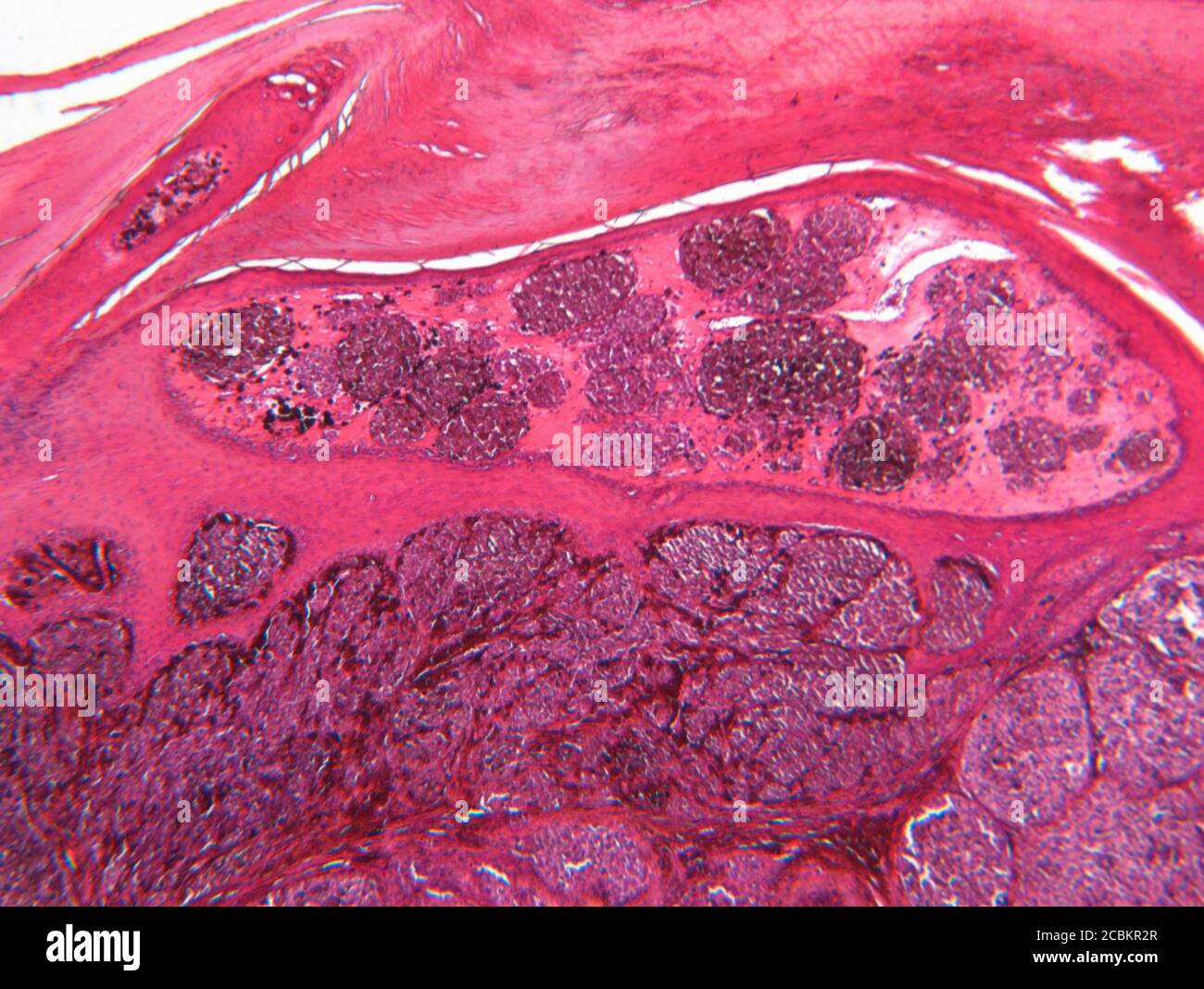 Microscope view of malignant melanoma Stock Photo - Alamy