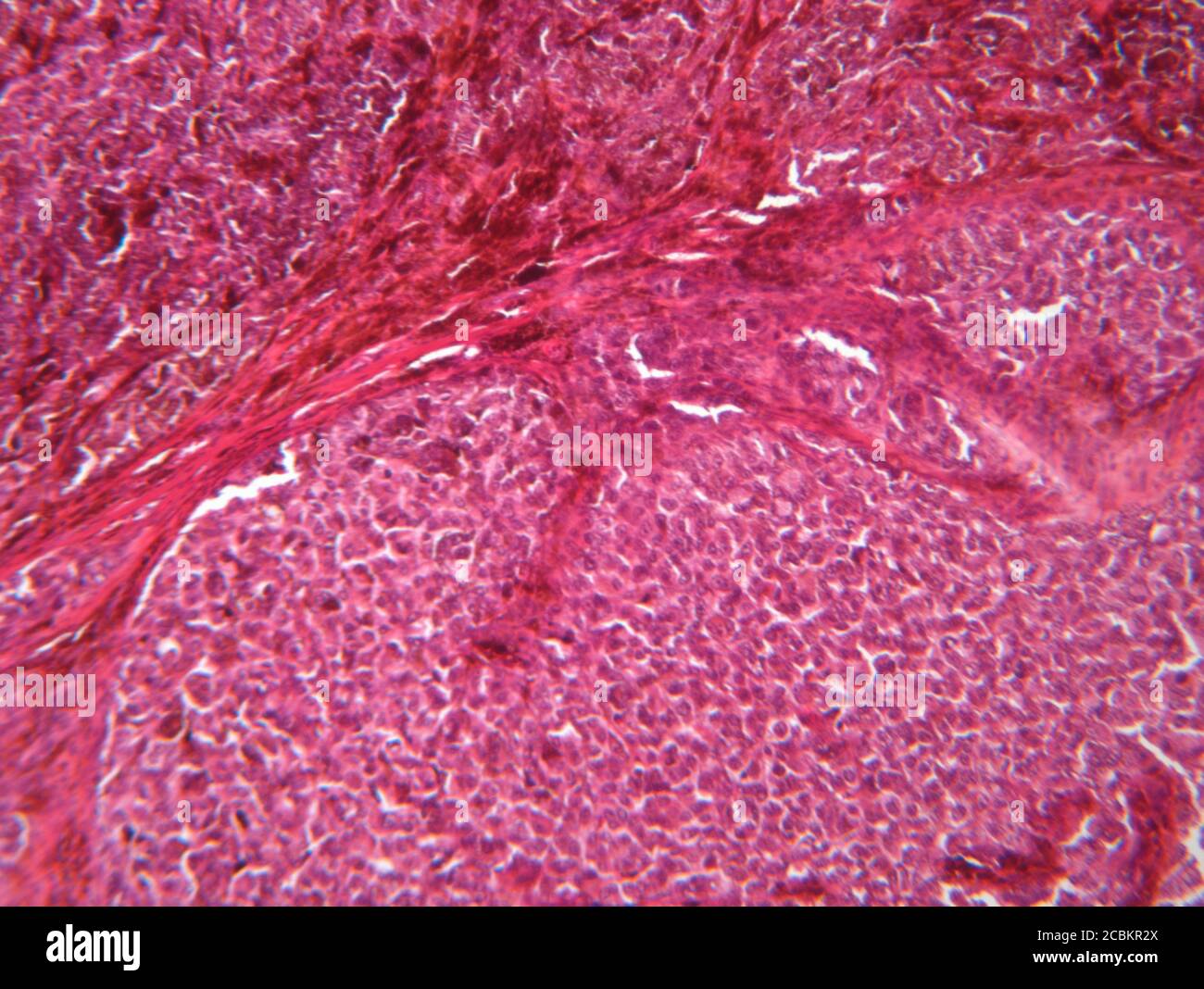 Malignant melanoma micrograph hi-res stock photography and images - Alamy