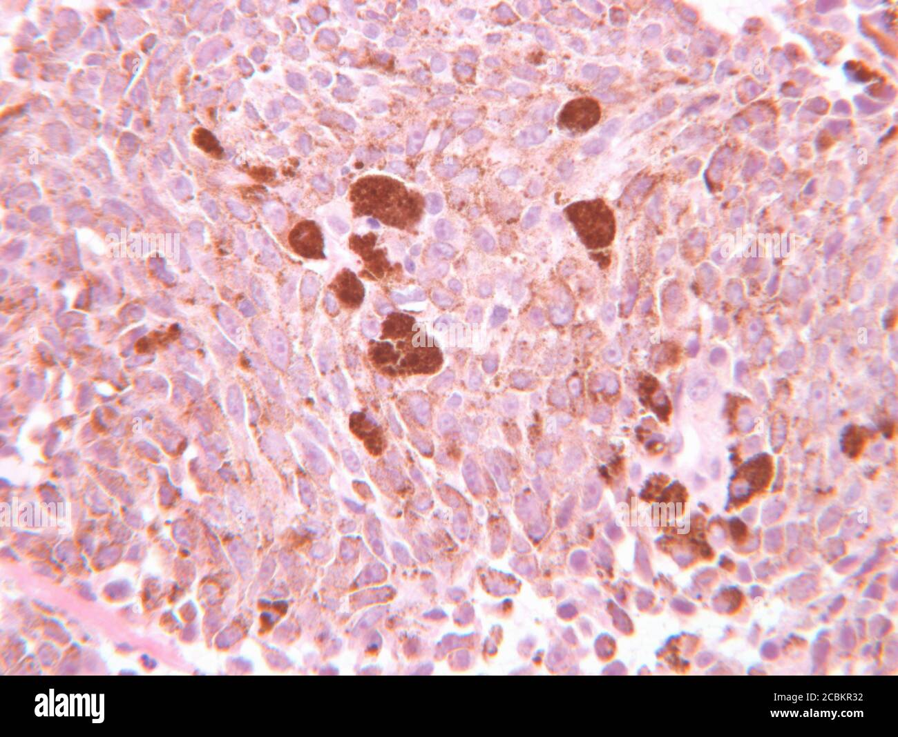 Malignant melanoma hi-res stock photography and images - Alamy