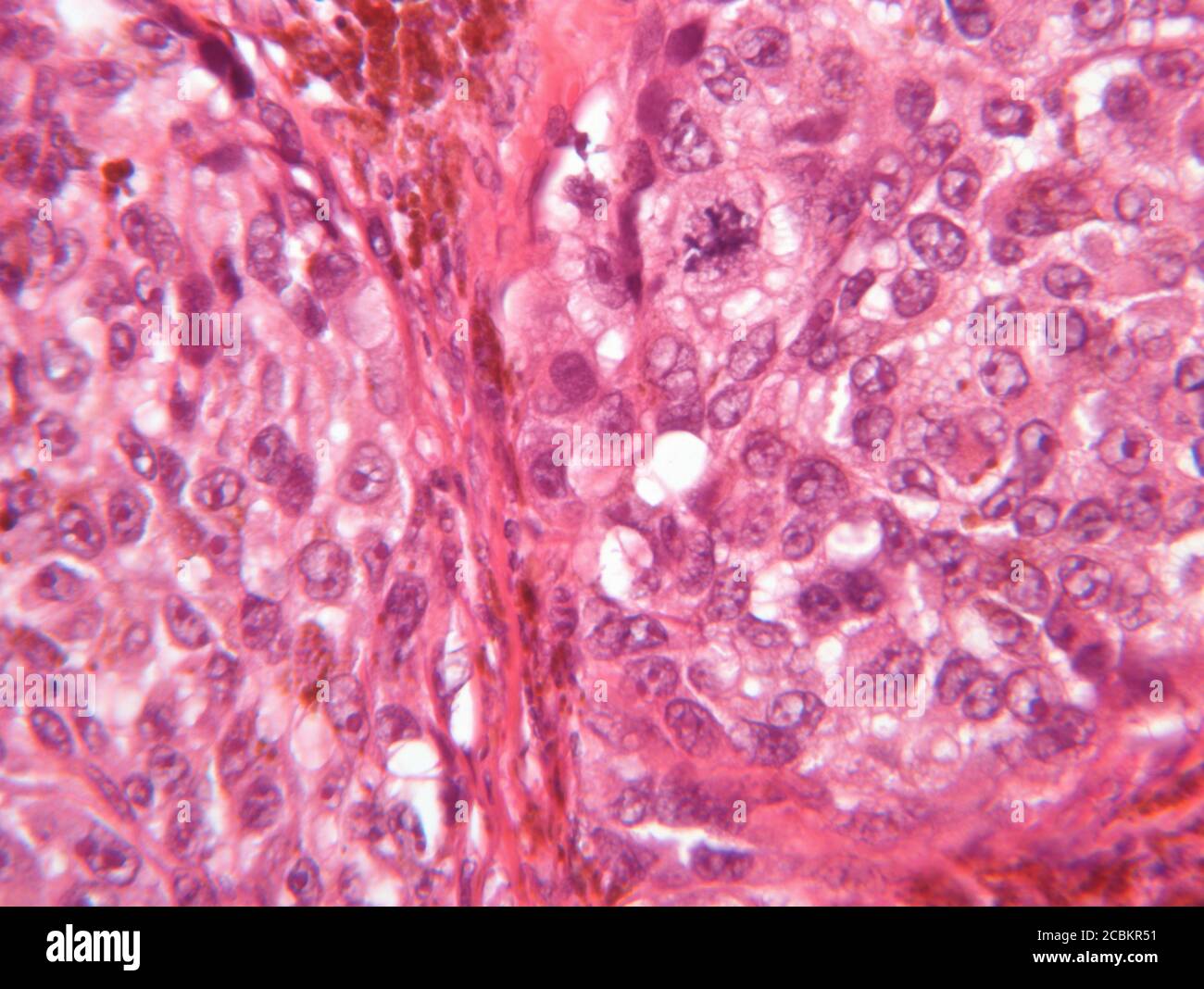 Malignant melanoma micrograph hi-res stock photography and images - Alamy