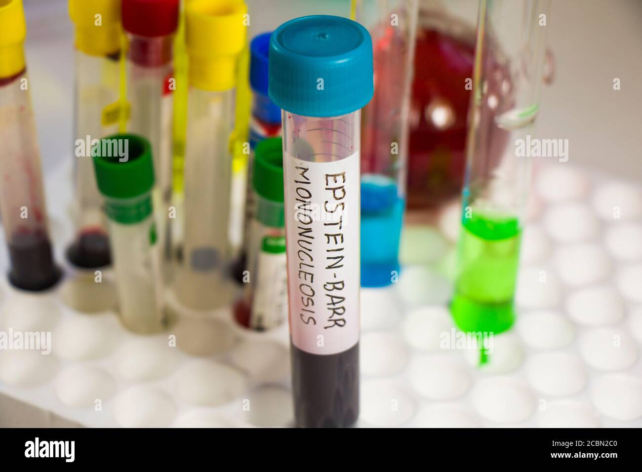 Mononucleosis and Epstein-barr virus blood test sample in lab on the ...