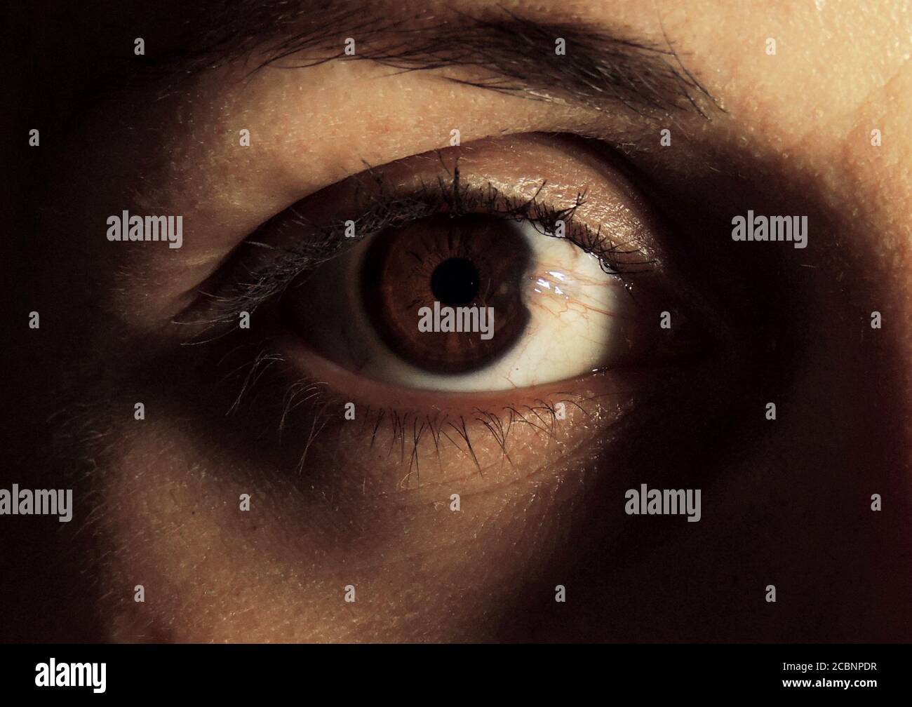 Close-up of a Pterygium or surfer's eye which is the growth of the ...