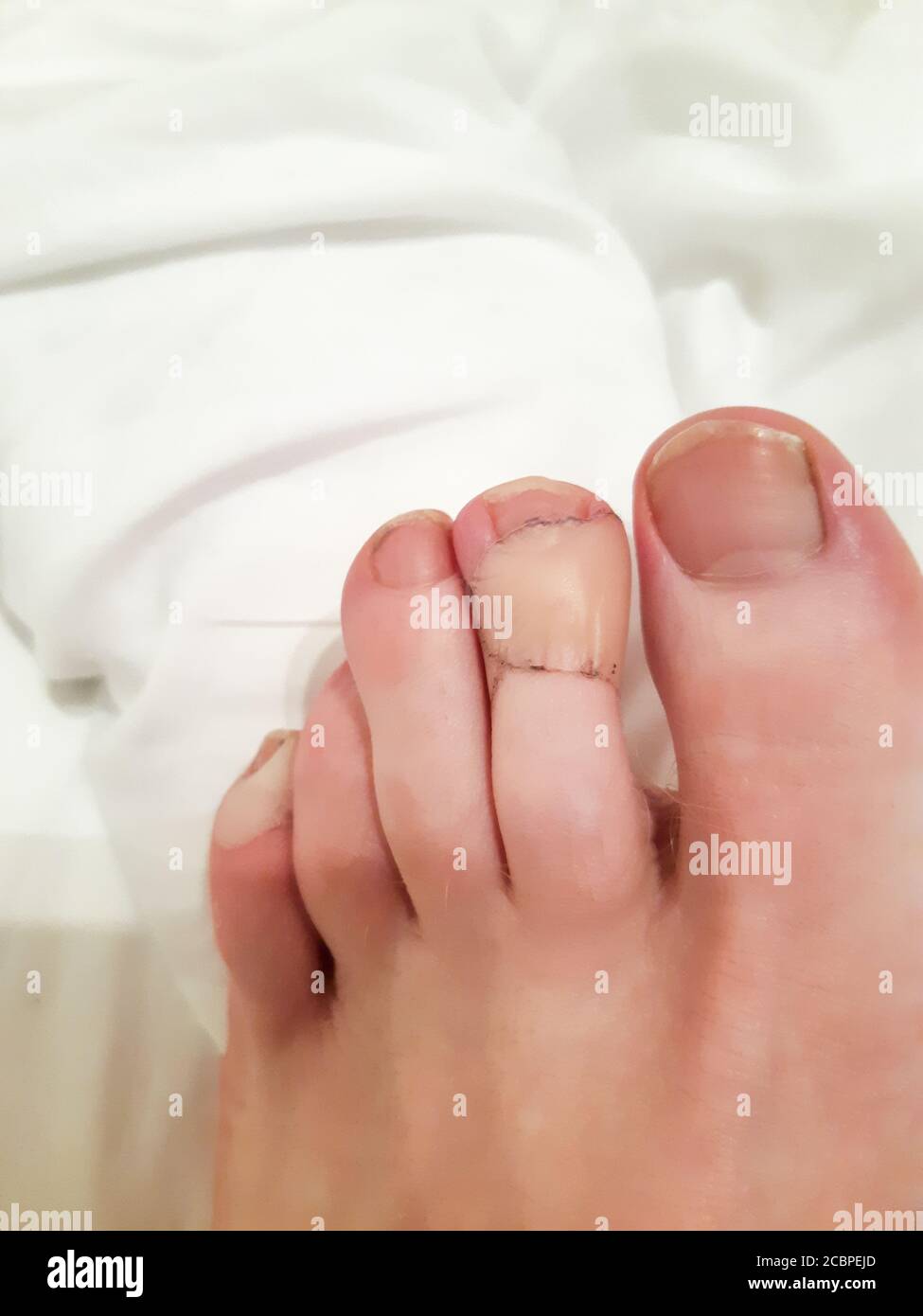 Broken toe closeup hi-res stock photography and images - Alamy