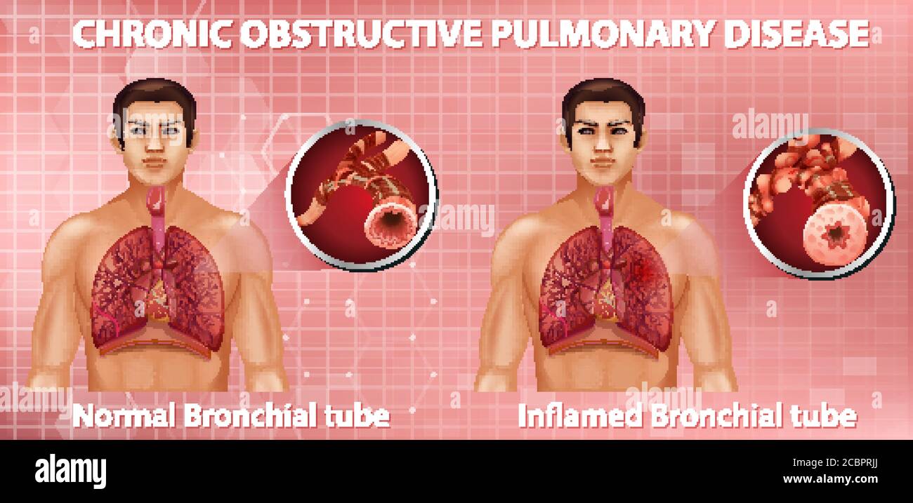 Chronic obstructive pulmonary disease illustration Stock Vector Image ...