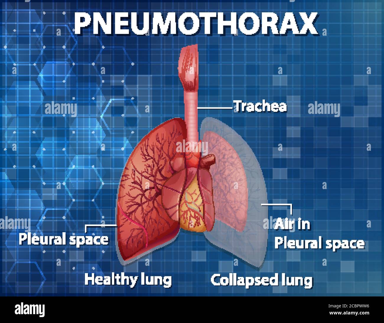 Informative illustration of Pneumothorax illustration Stock Vector ...