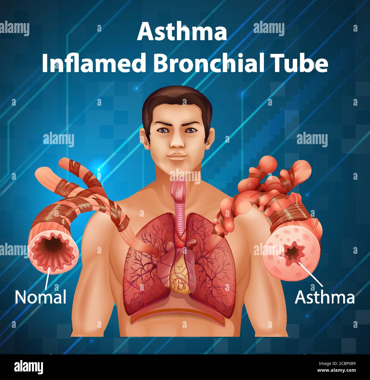 Human anatomy Asthma Inflamed Bronchial Tube diagram illustration Stock ...