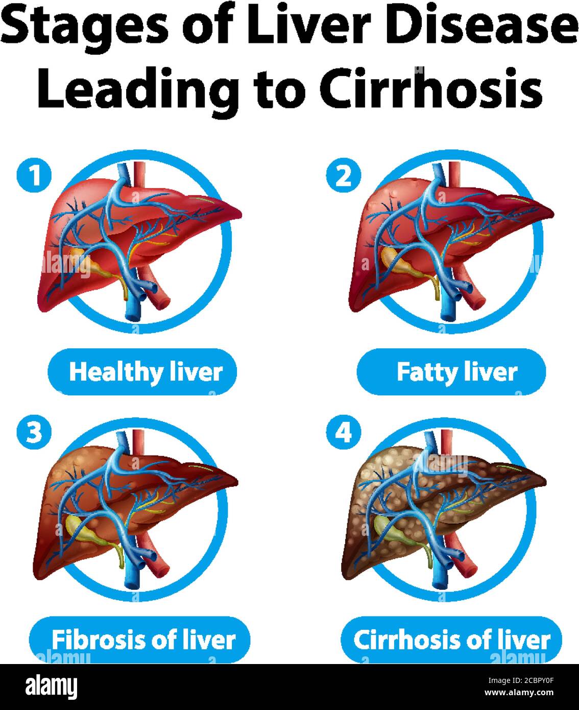 Stages of liver disease leading to Cirrhosis illustration Stock Vector ...