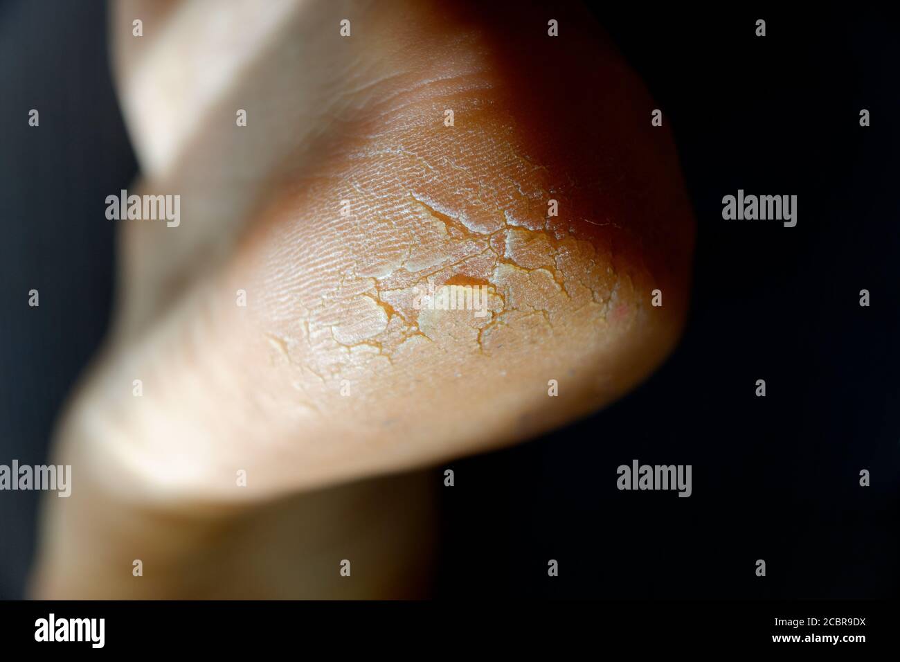 Cracked and dry heel of the foot skin Stock Photo - Alamy