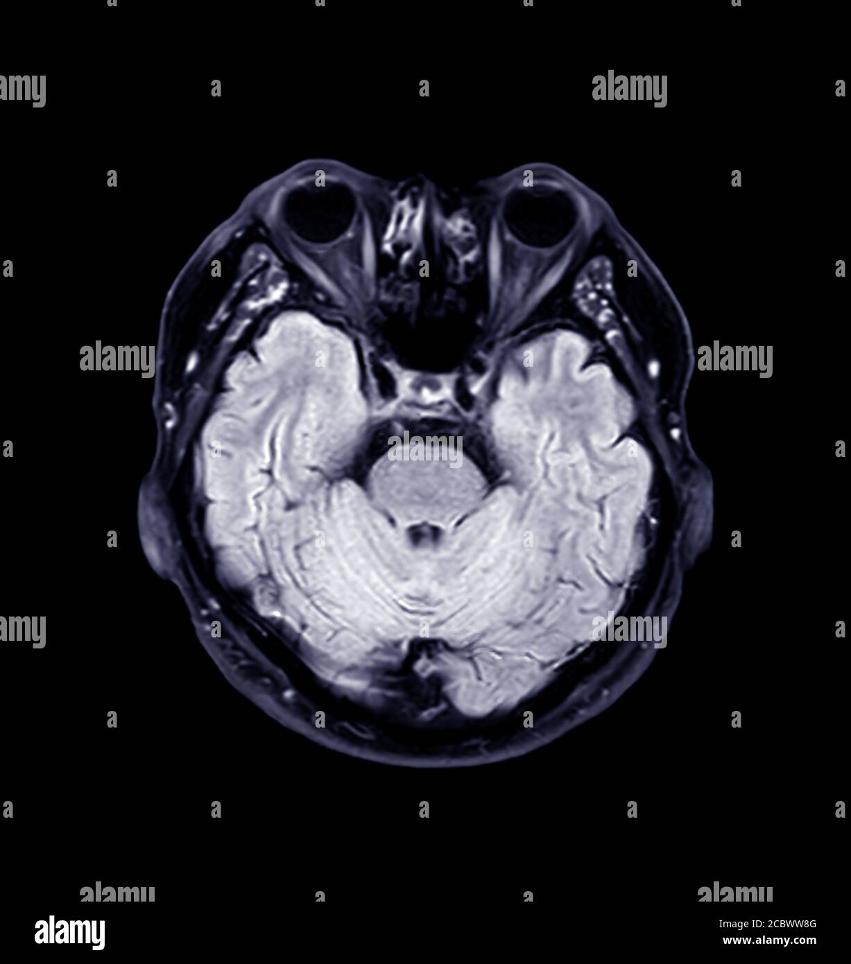 MRI of the brain Axial T2 flair view for detect a variety of conditions of the brain such as ...