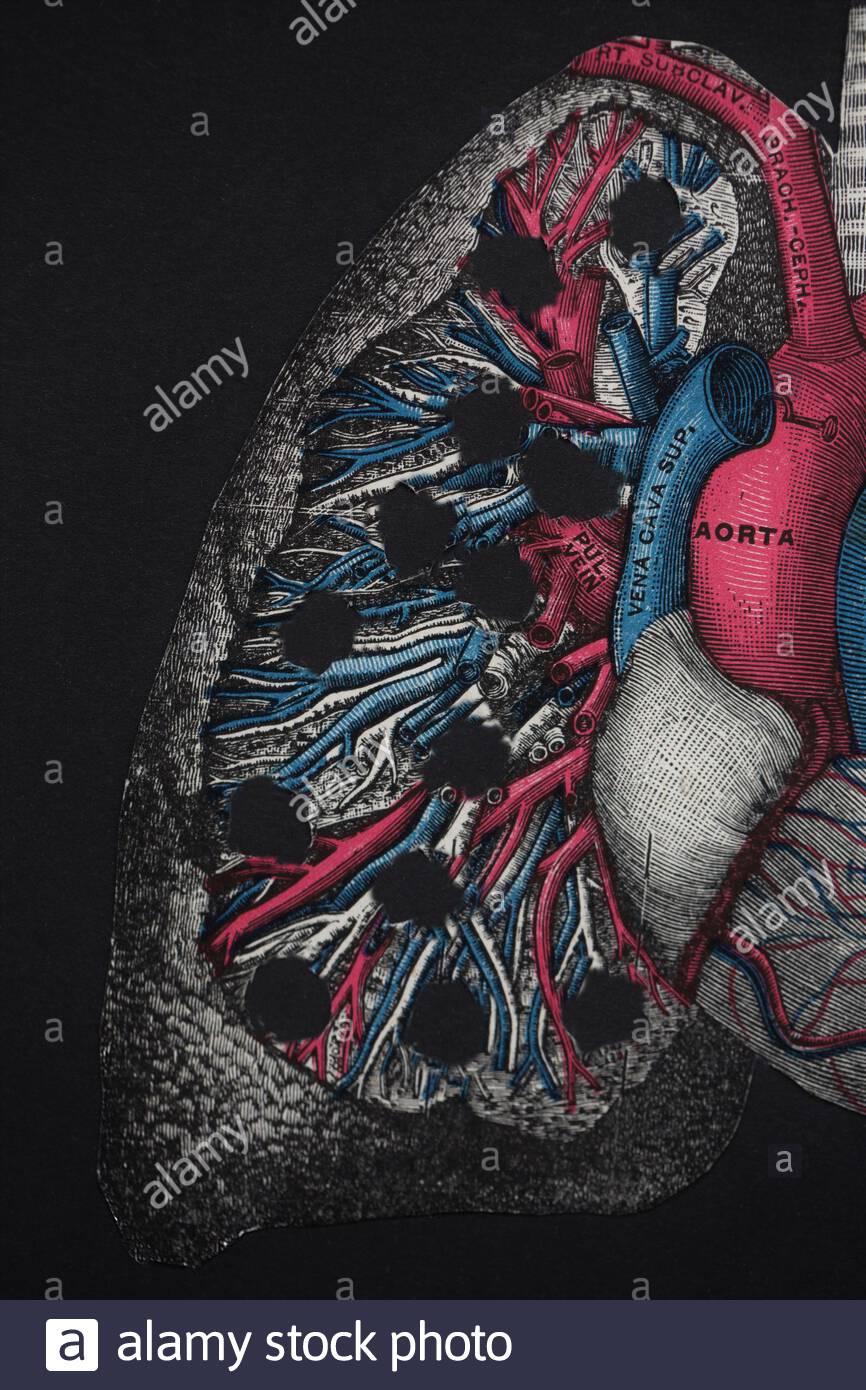 Diseased Lung High Resolution Stock Photography and Images - Alamy