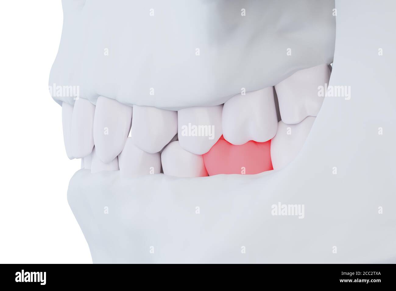 human jaw with a sore tooth, red lower sixth molar tooth, 3d render ...