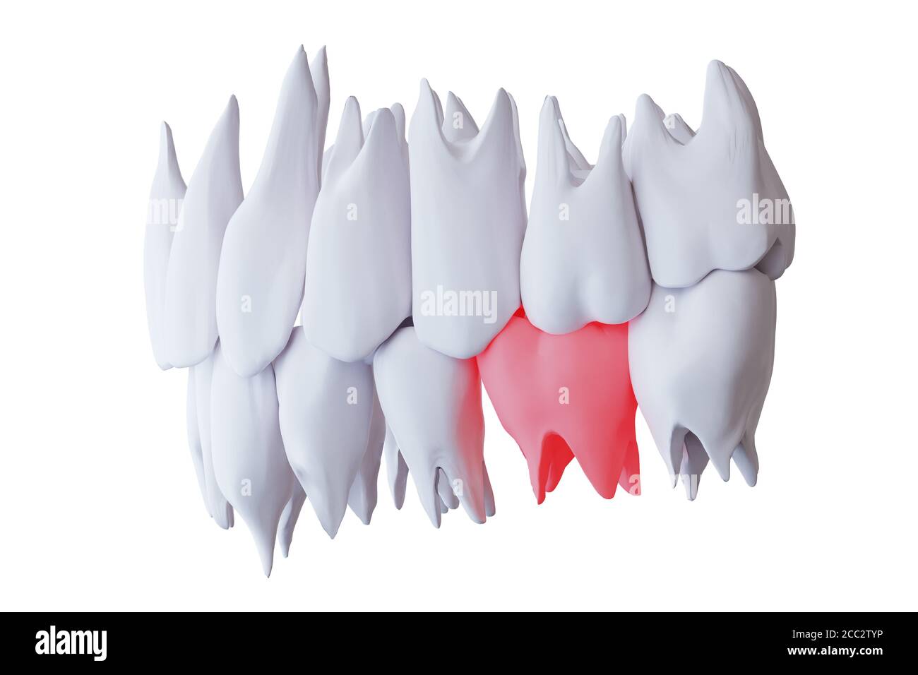 human teeth with a sore tooth, red lower sixth molar tooth, isolated on ...