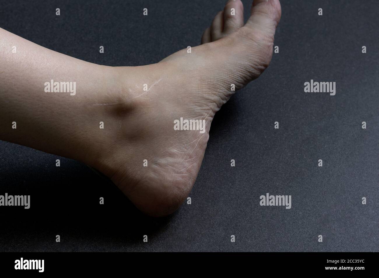 Bone fracture hi-res stock photography and images - Alamy