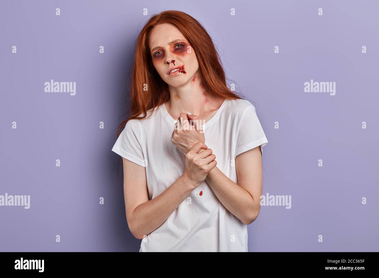 ginger girl with black eyes has broken her arm, woman has pain in her ...