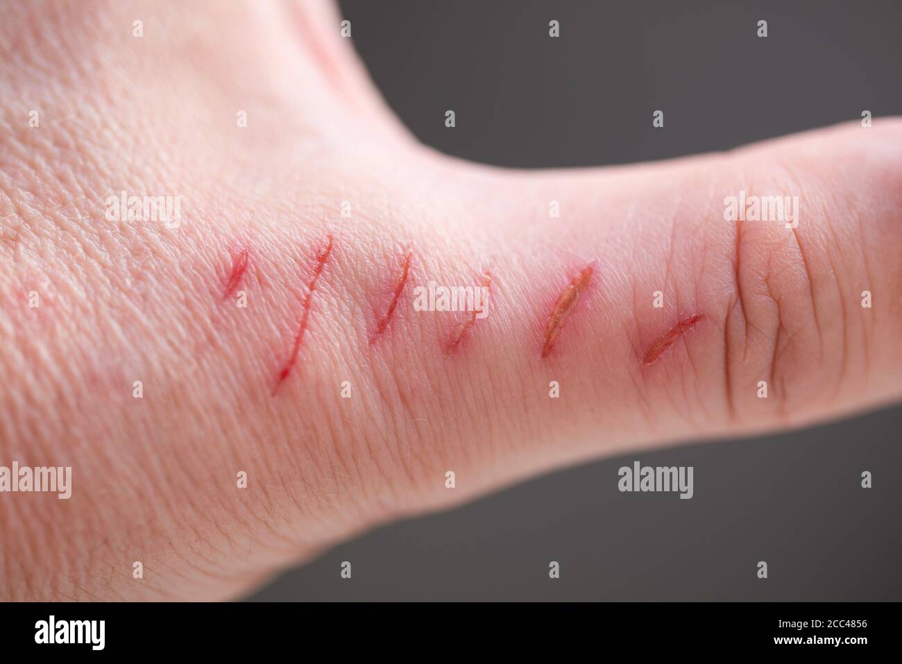 Finger with parallel scratches, many scratches on dark background Stock ...