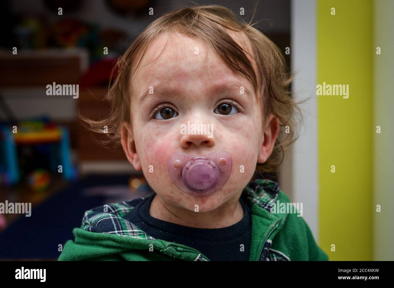 Children viral disease or allergies. Red measles rash on baby. Child ...