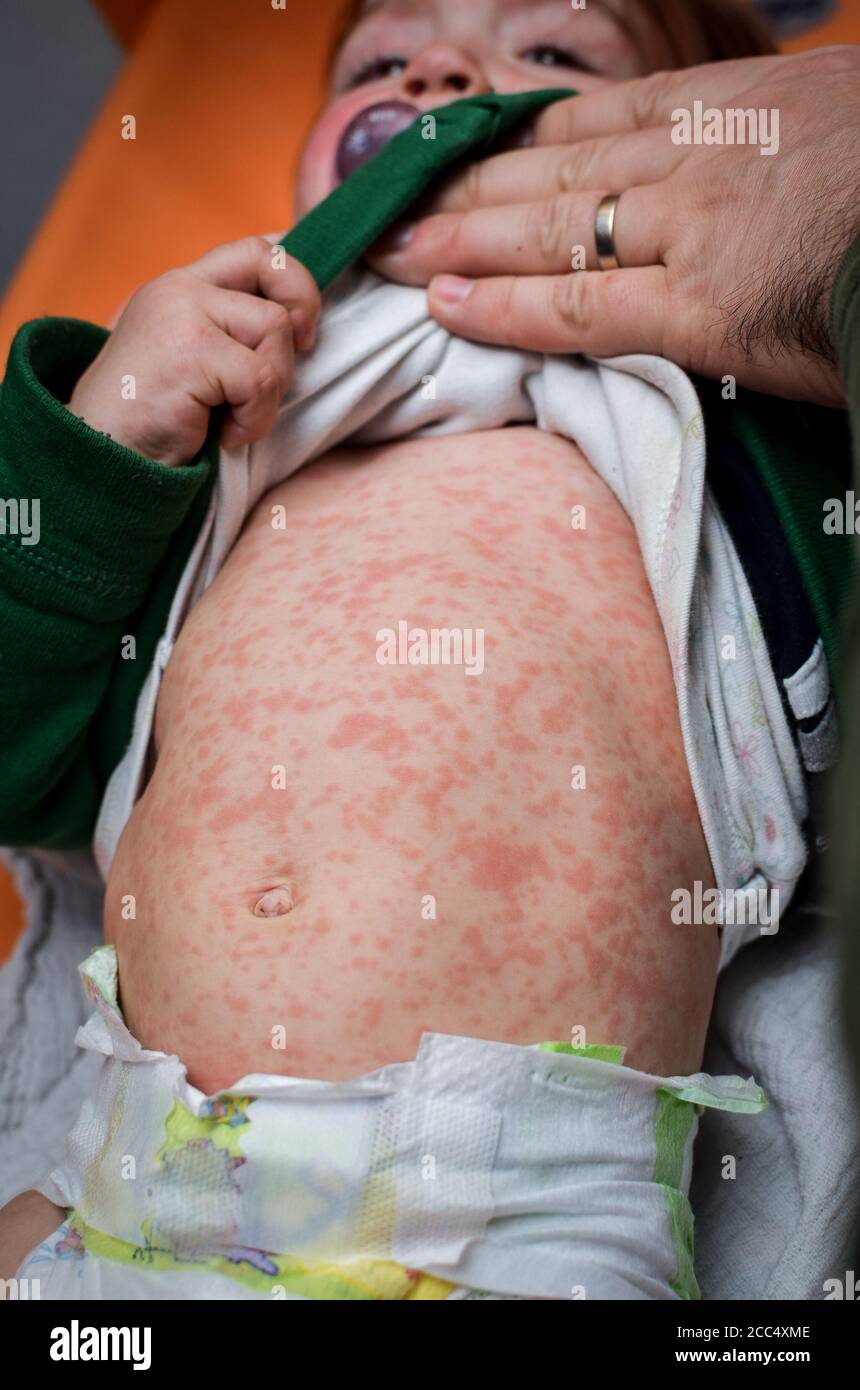 Measles Baby