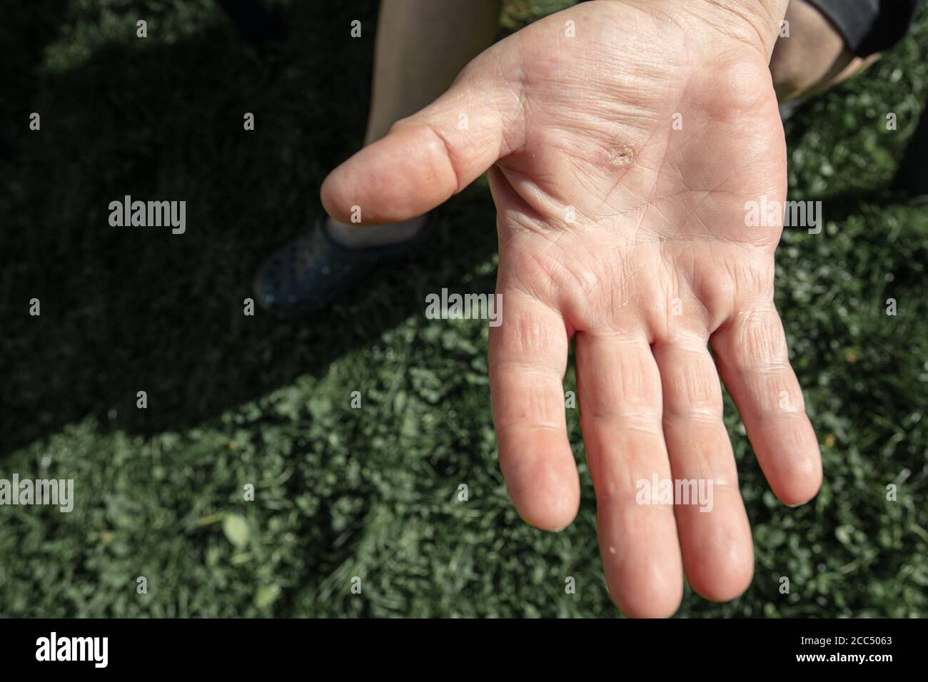 Calluses on the hands, Close-up of male hands. High quality photo Stock ...
