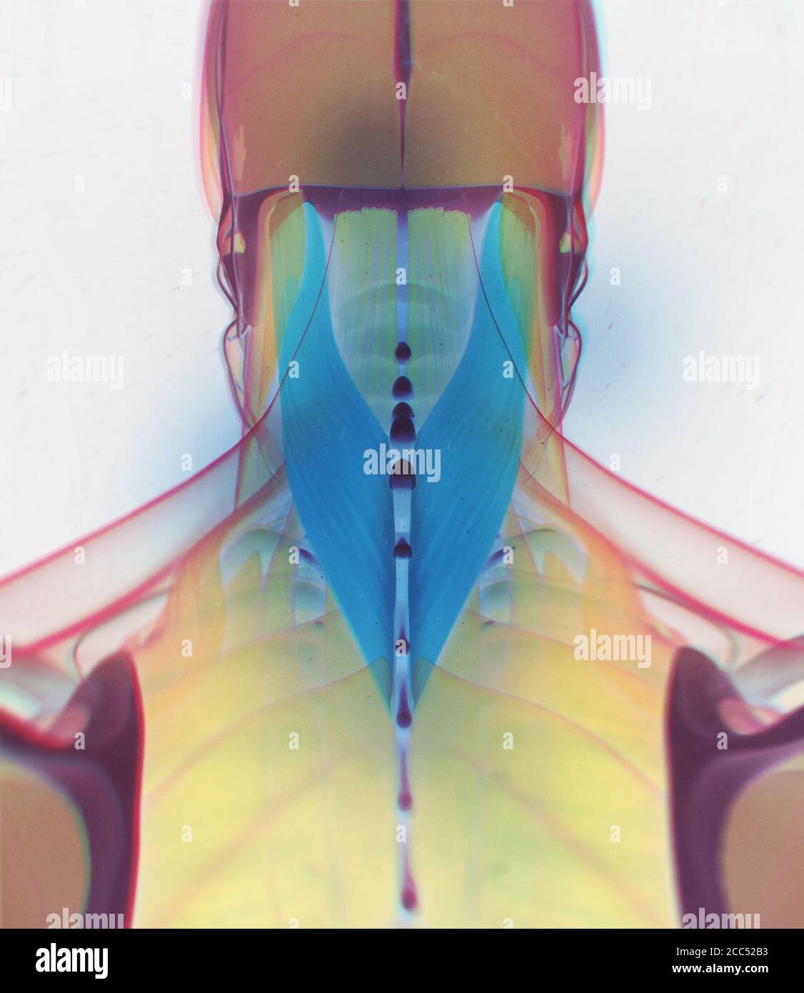 Splenius Capitis, neck muscles, stress, human anatomy. 3D illustration ...