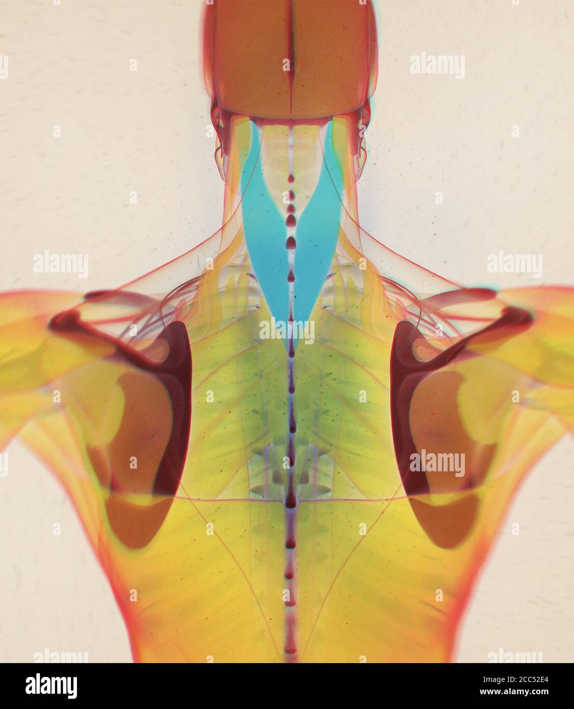 Splenius Capitis, neck muscles, stress, human anatomy. 3D illustration ...