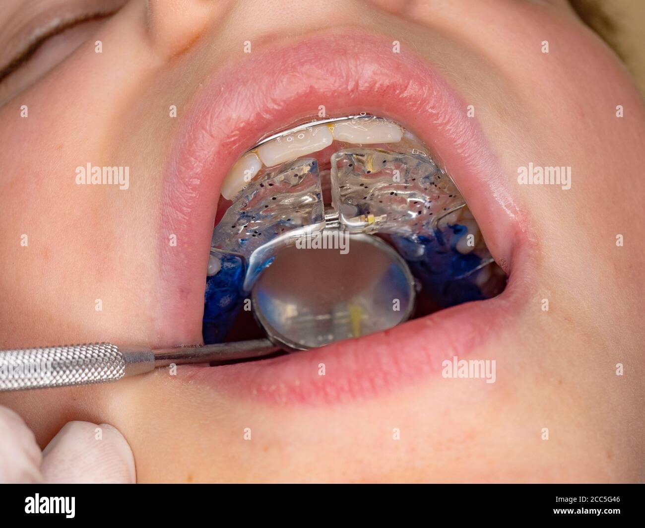 Palatal defect hi-res stock photography and images - Alamy