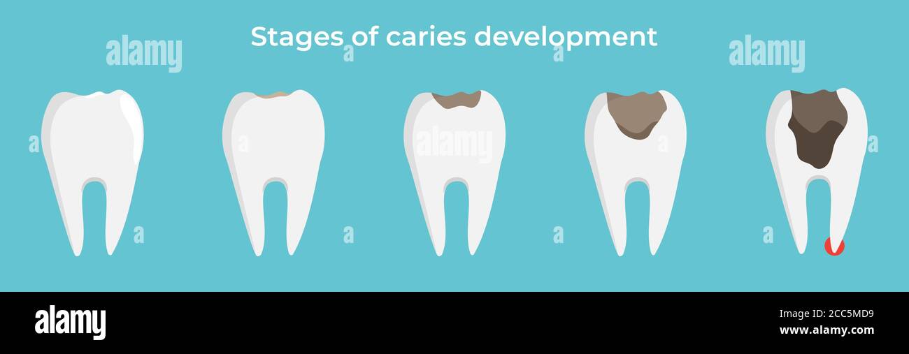 Stages of caries development, tooth dekay, dental concept, vector ...