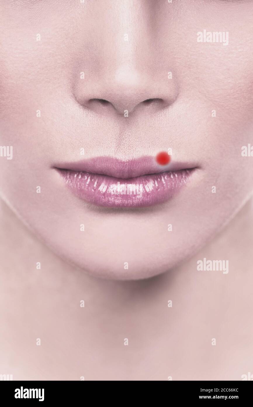 Cold sore blister red pimple on upper lips of woman with herpes. Design ...
