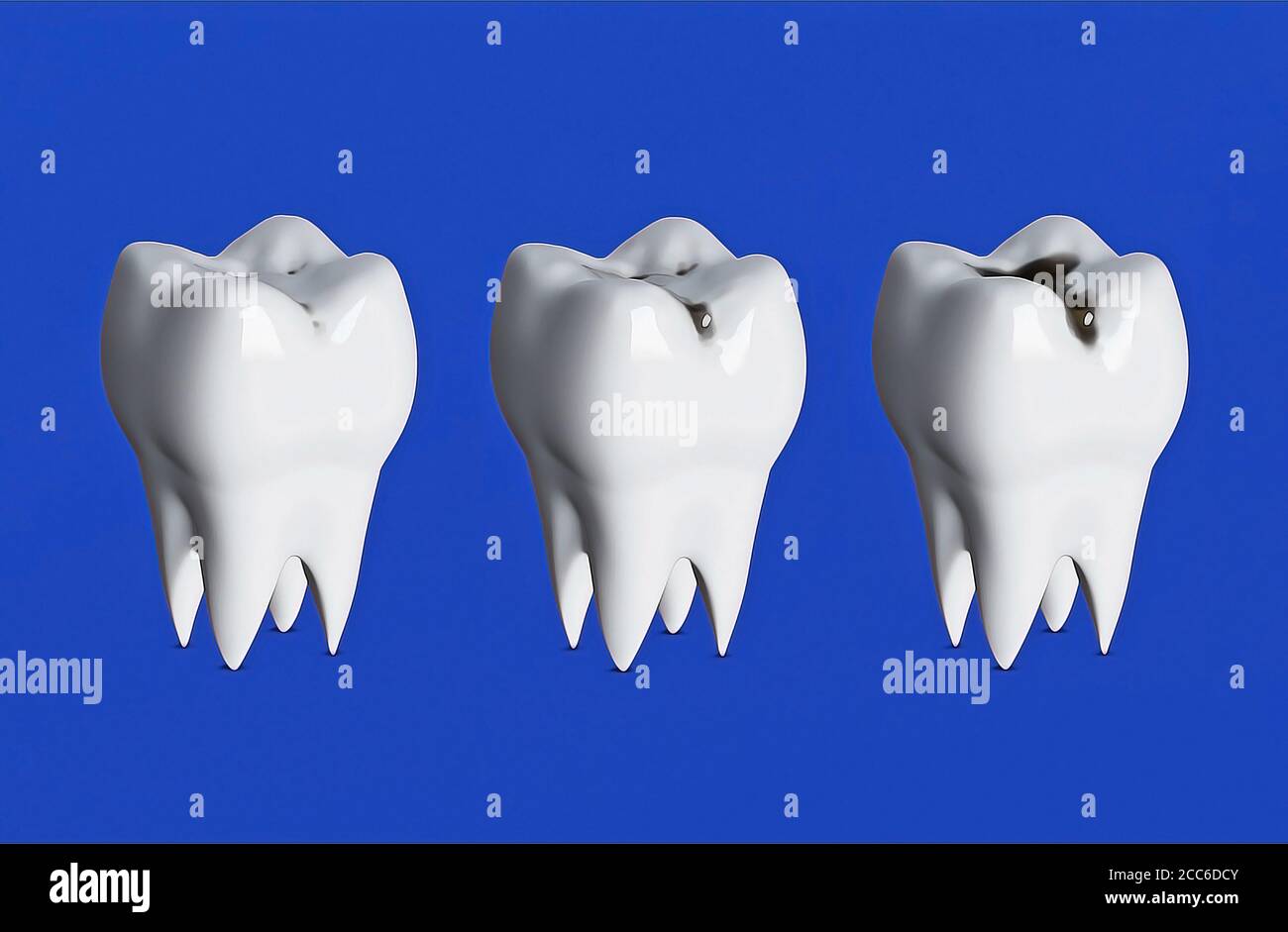 Three teeth in a row, Three stages of tooth decay, caries, sore teeth ...