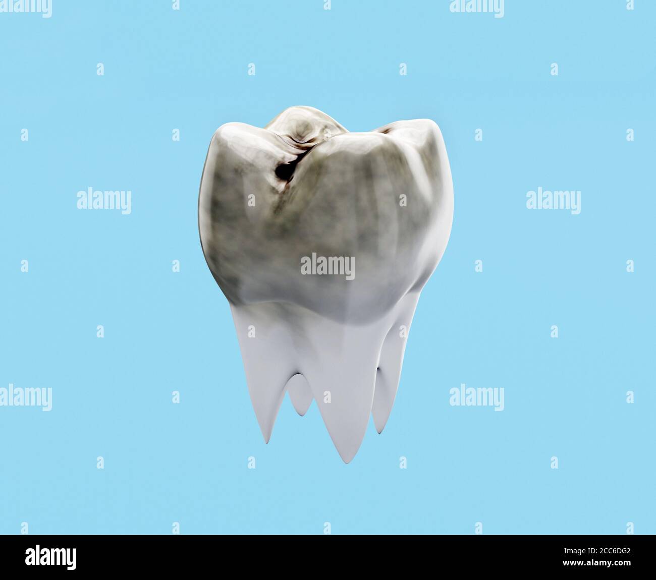 Carious molar tooth on blue background, tooth decay concept, caries, 3d ...