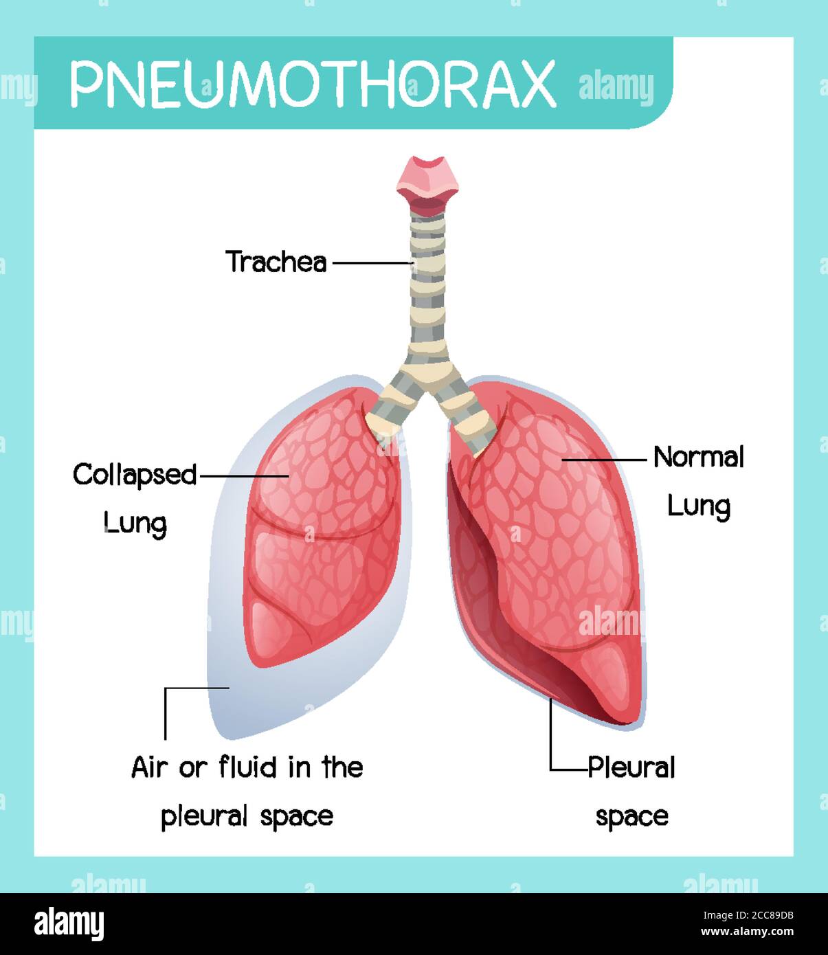 Pneumothorax High Resolution Stock Photography and Images - Alamy