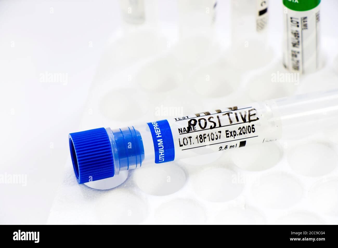 HIV and aids infection test, doctors face and hand holding tube with ...