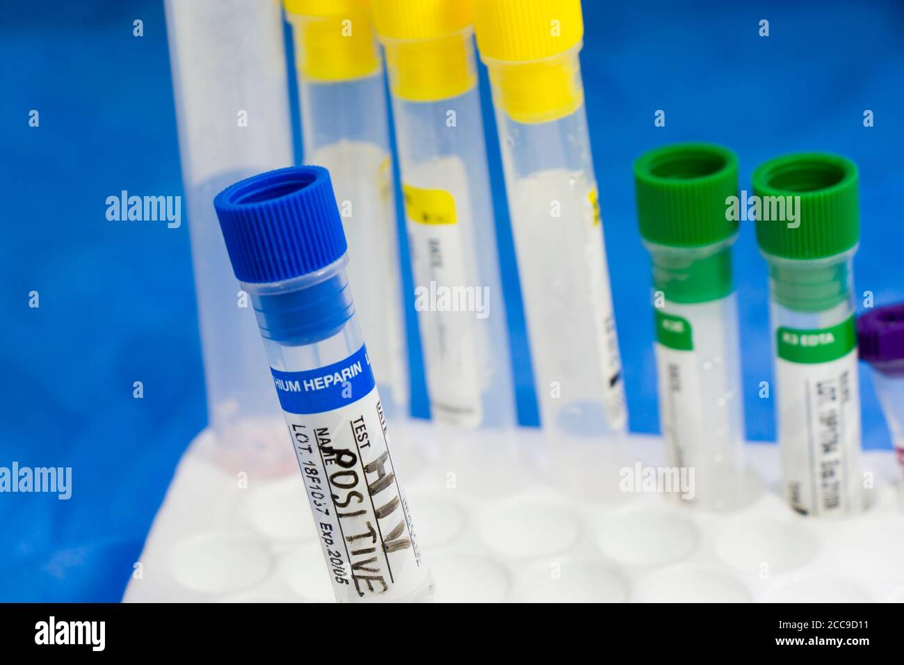 HIV and aids infection test, doctors face and hand holding tube with ...