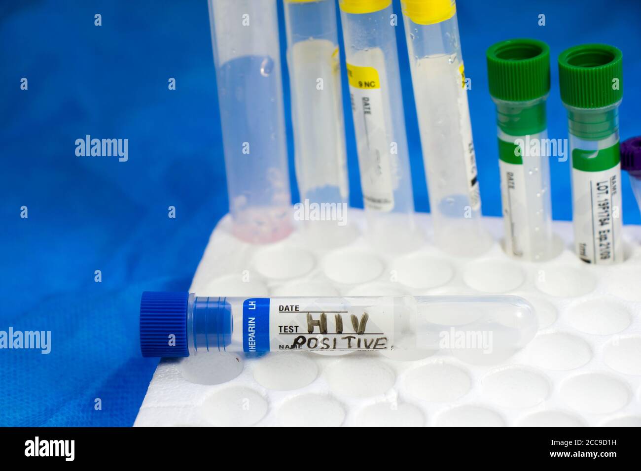 HIV and aids infection test, doctors face and hand holding tube with ...