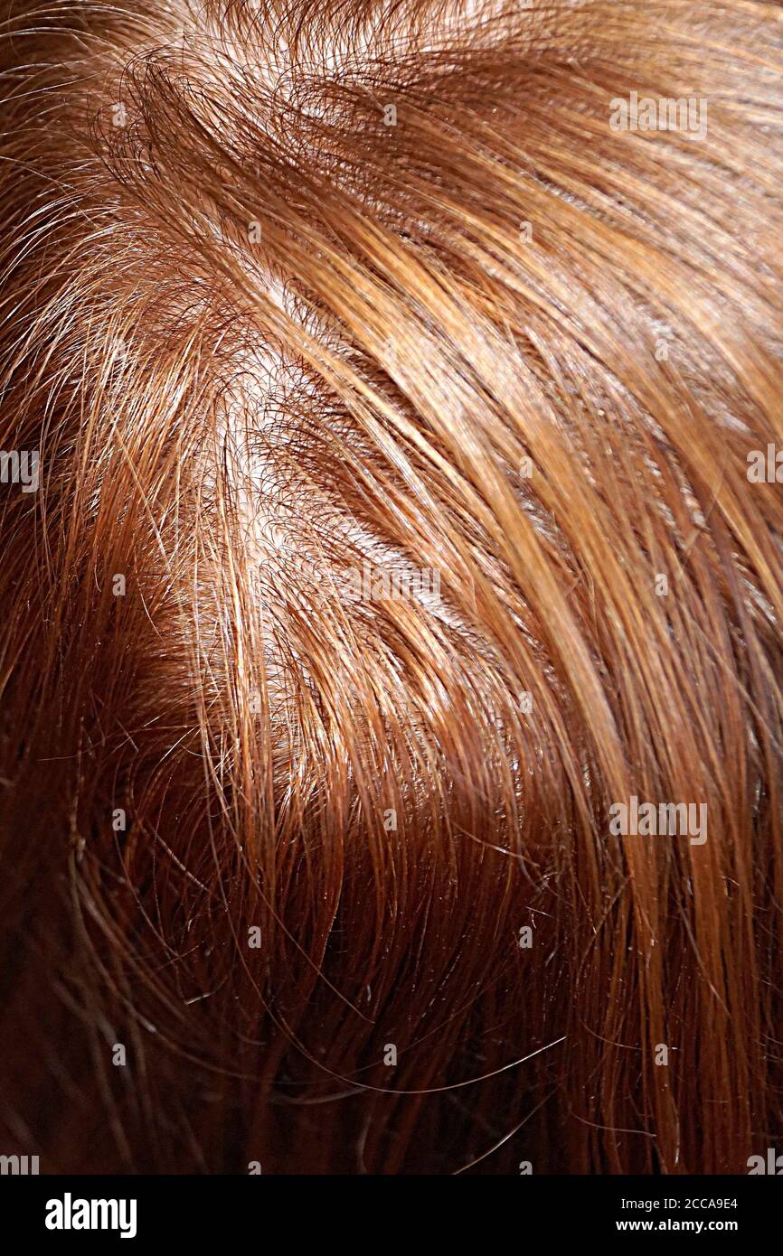 Lice In Red Hair