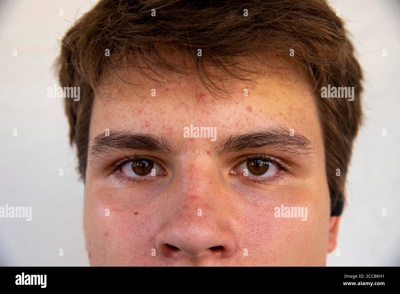 Close-up of the face of a young man suffering from acne Stock Photo - Alamy