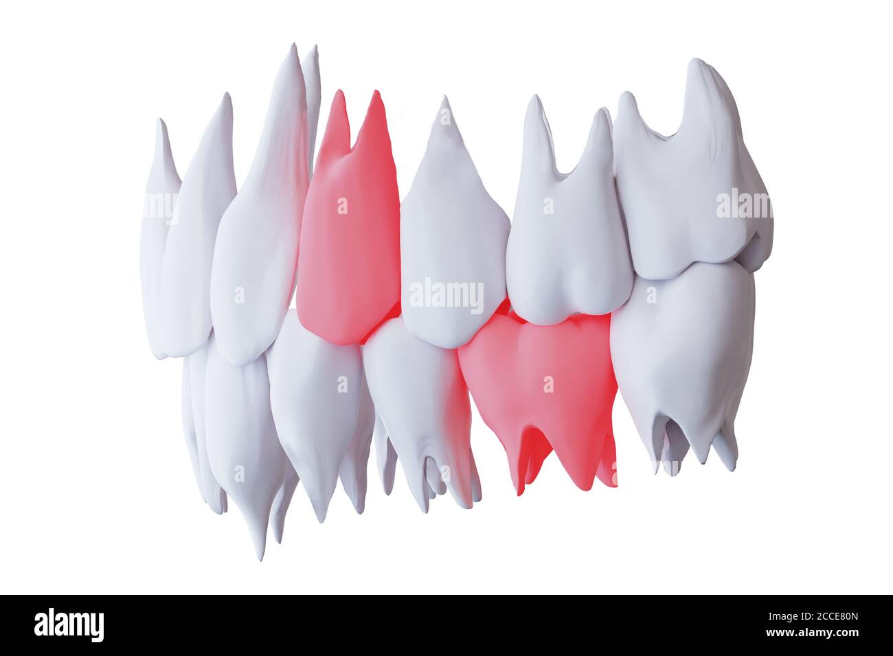 human teeth with a sore tooth, red lower sixth and upper fourth molar ...