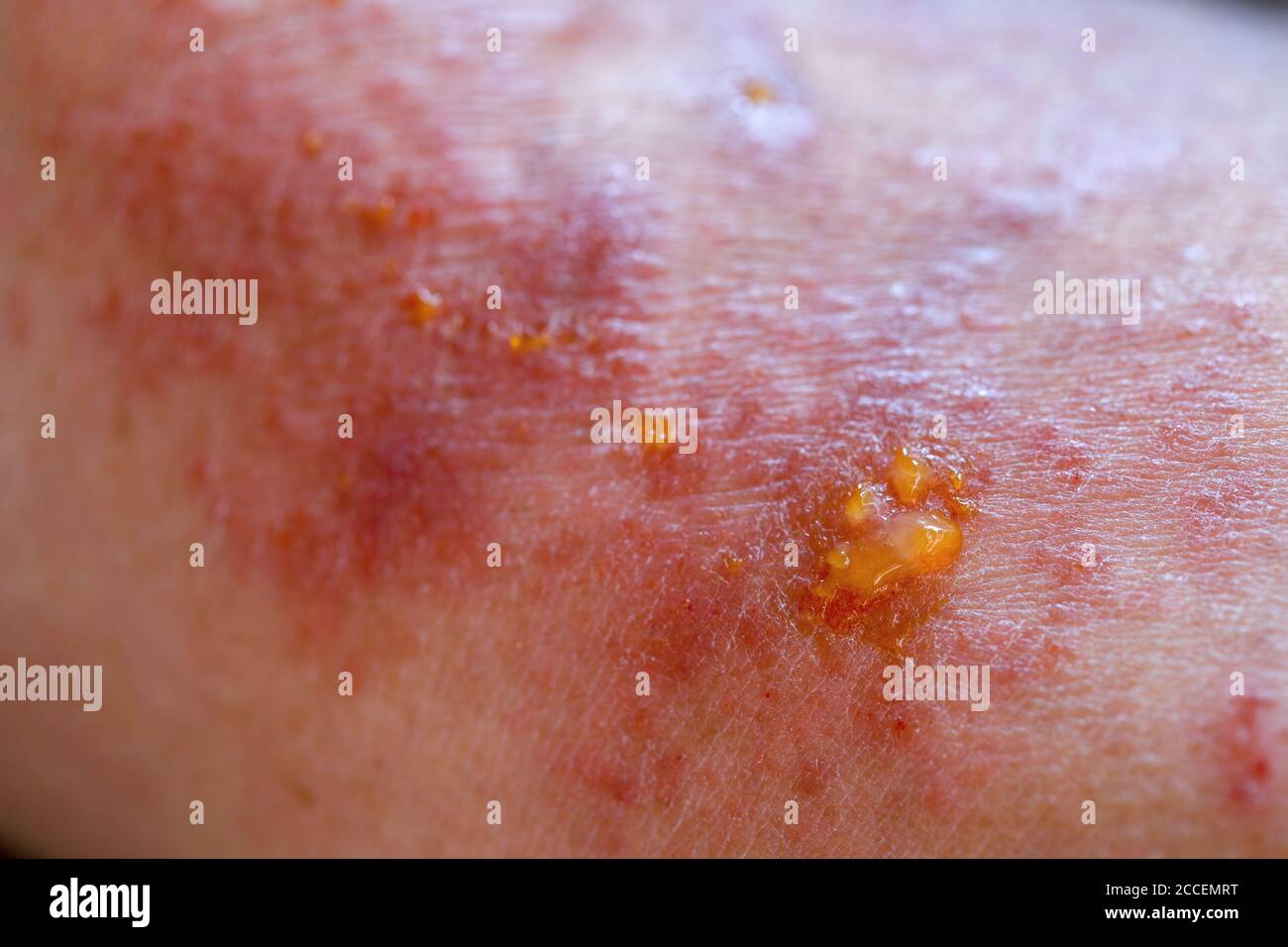 Skin Rash On Elbow High Resolution Stock Photography and Images - Alamy