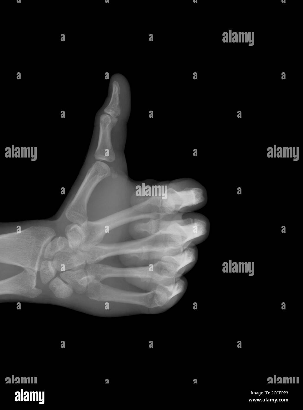 X ray normal hand hi-res stock photography and images - Alamy