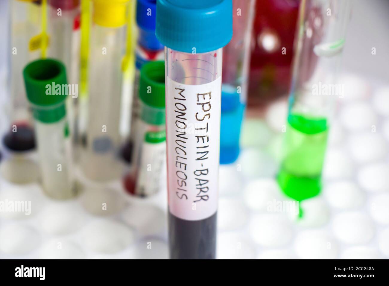Mononucleosis and Epstein-barr virus blood test sample in lab on the ...