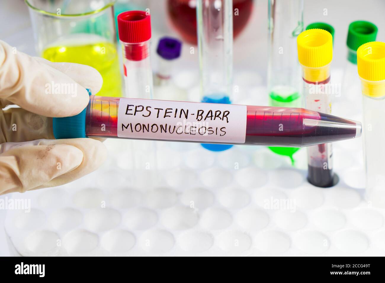 Epstein barr virus hi-res stock photography and images - Alamy