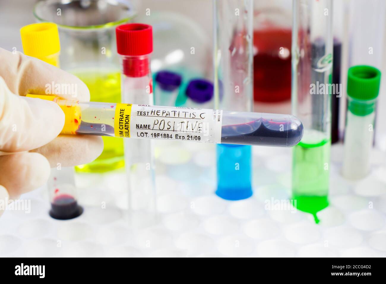 Sclera jaundice hi-res stock photography and images - Alamy