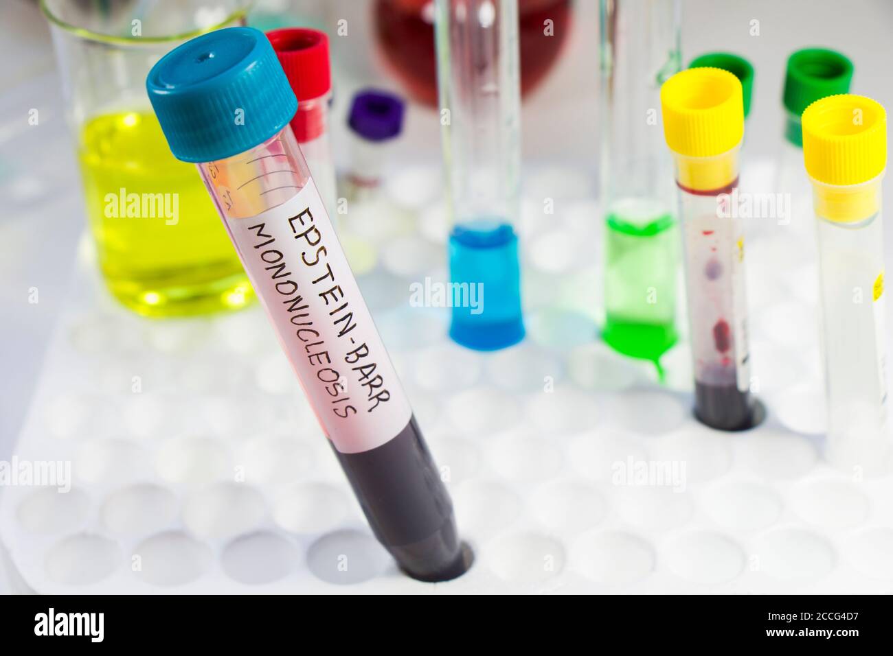 Mononucleosis and Epstein-barr virus blood test sample in lab on the ...