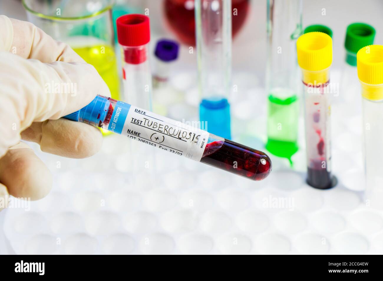 Tuberculosis blood test tube laboratory hi-res stock photography and ...