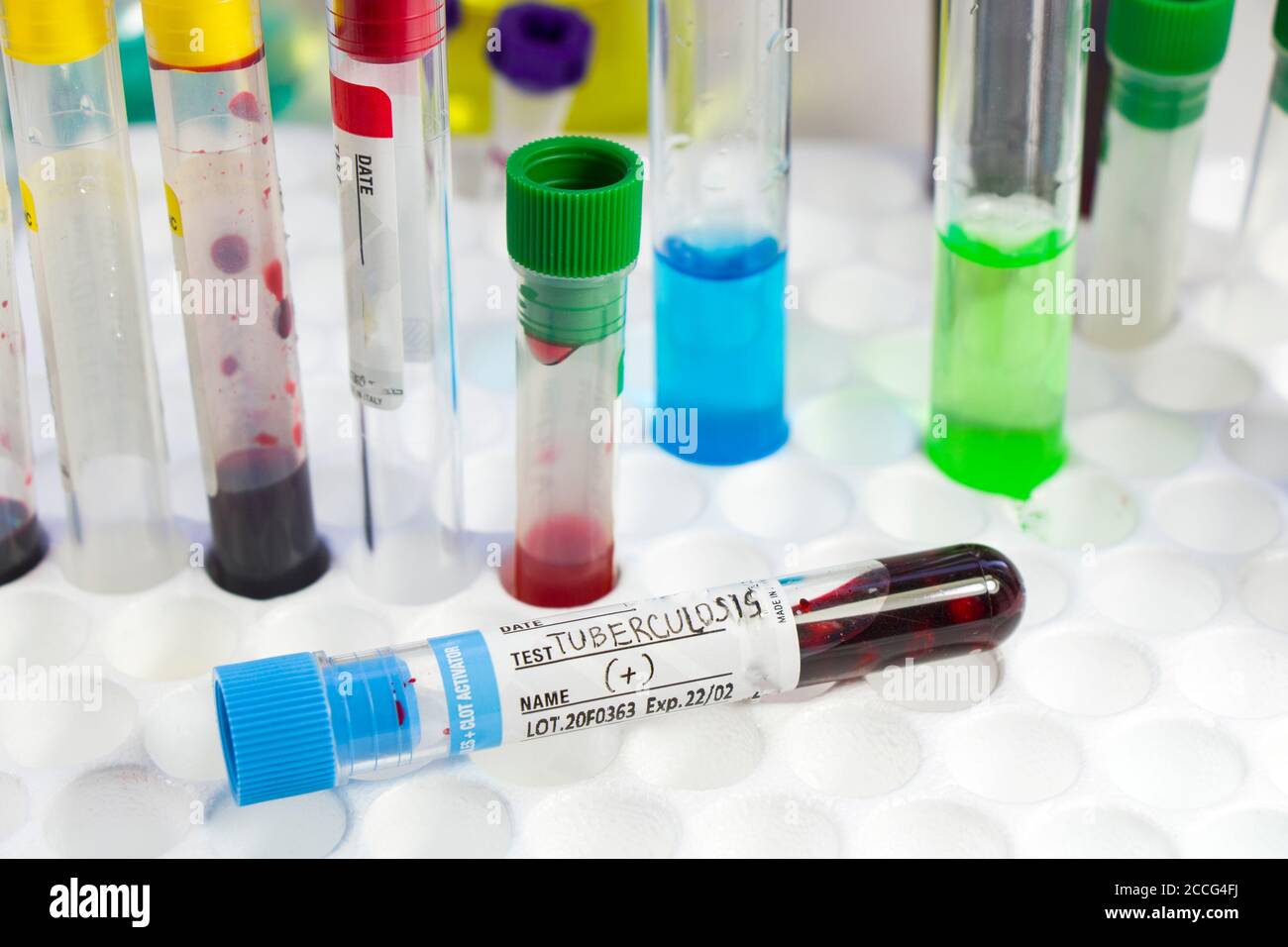 Tuberculosis blood test tube, laboratory and diagnoses Stock Photo - Alamy