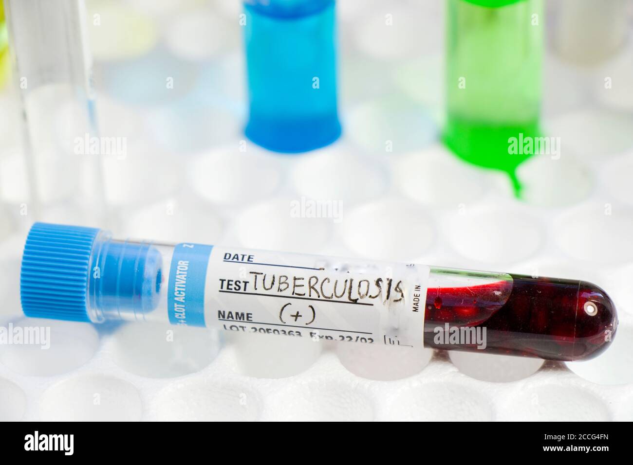Tuberculosis blood test tube, laboratory and diagnoses Stock Photo - Alamy
