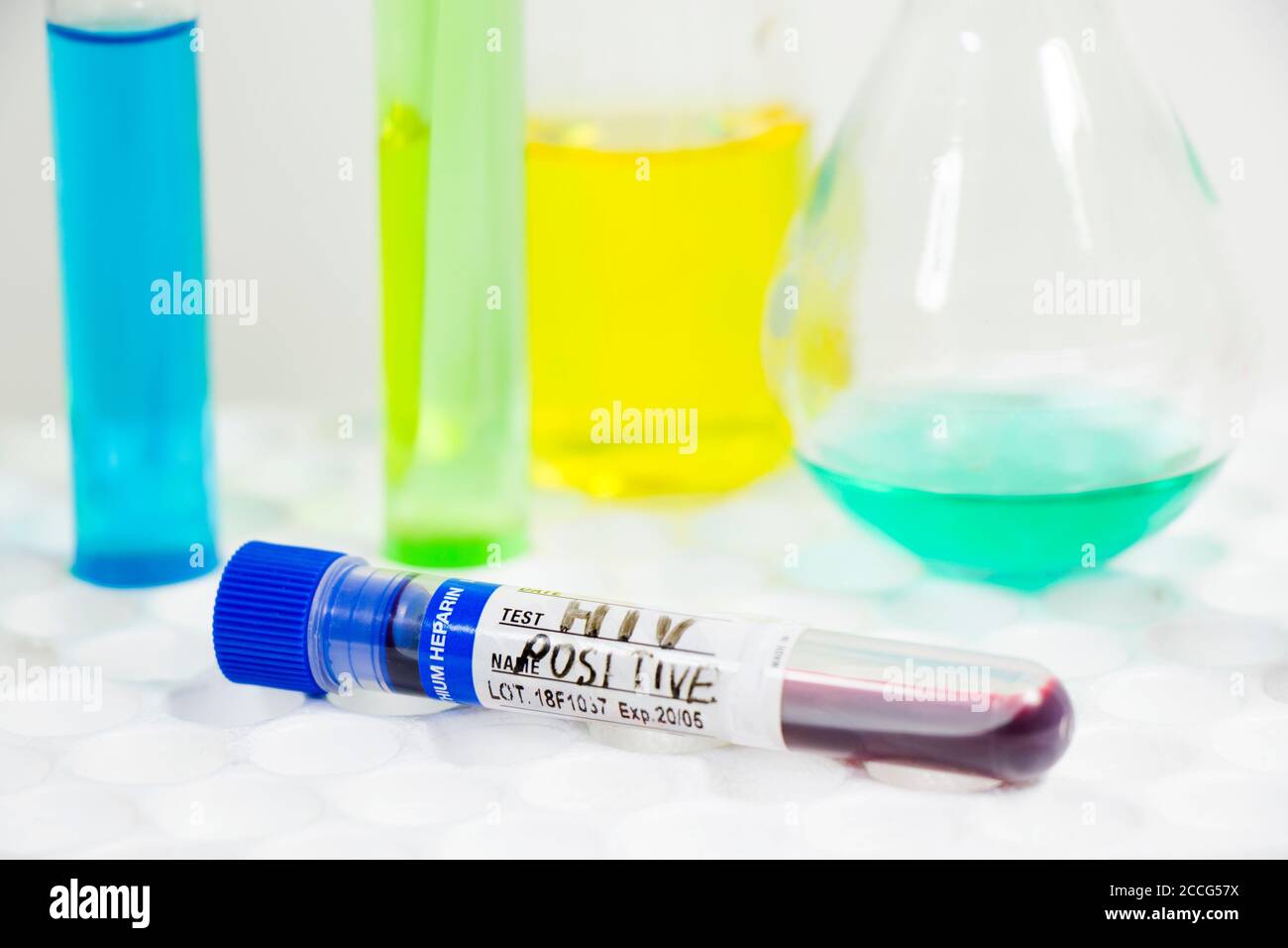 HIV blood test tube sample, aids immune viruses Stock Photo - Alamy